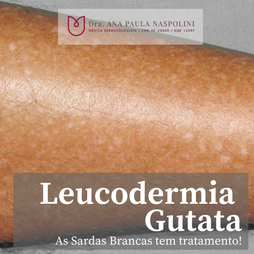 Leucodermias Gutatas: as sardas brancas tem tratamento! – Dra. Ana ...